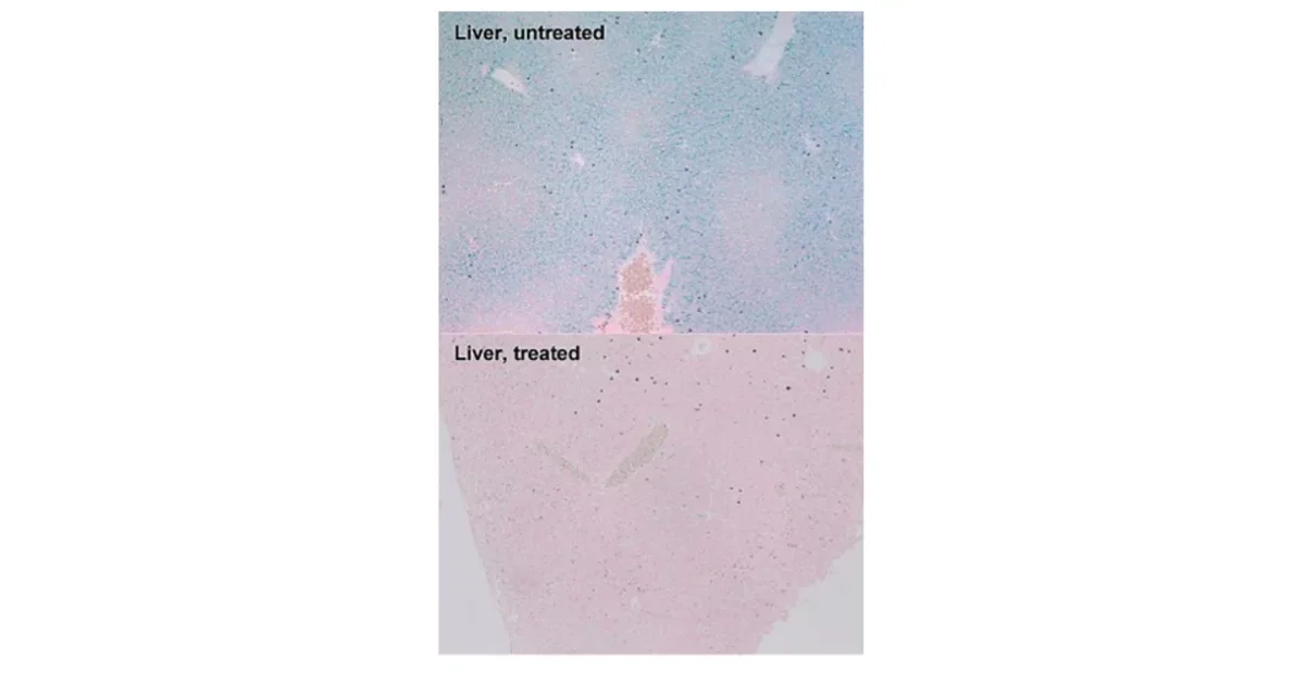 UCLA scientists develop potential new treatment for iron-overload ...